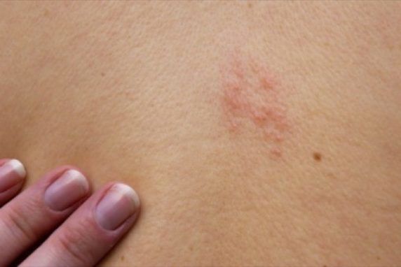 Early Signs You May Have Shingles, Learn The Symptoms and Treatment ...